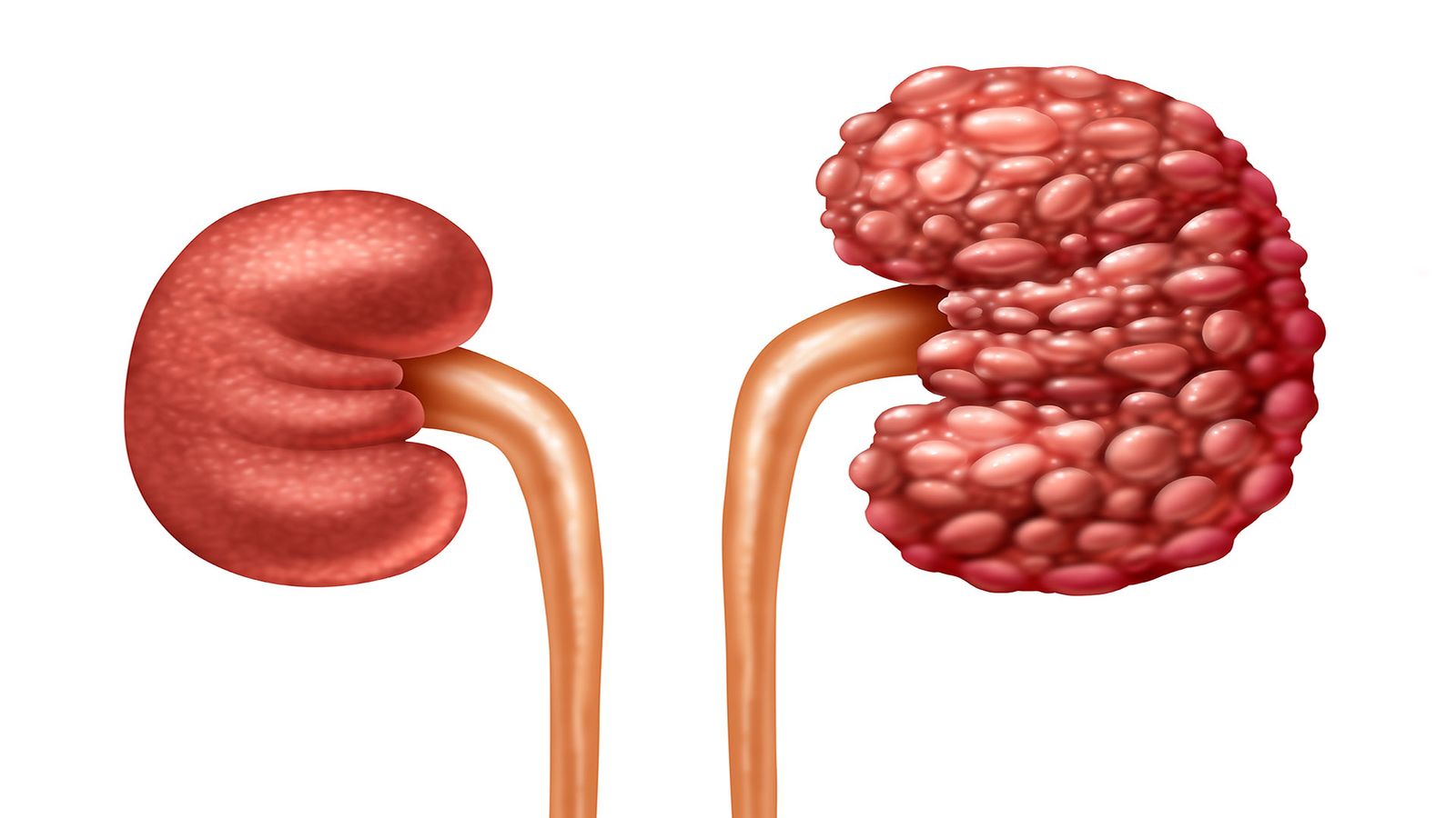 Rins Policísticos: O que é, causas e Como funciona