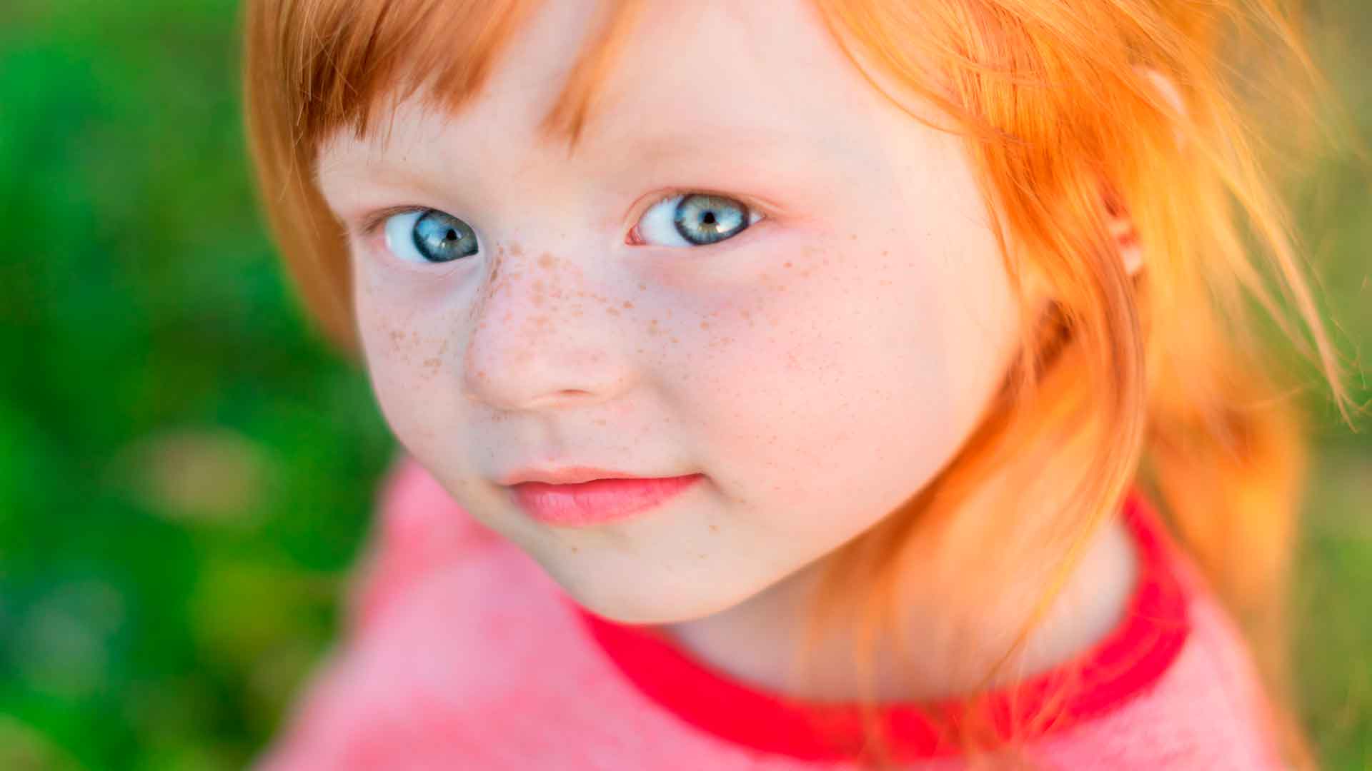 Xeroderma Pigmentoso: o que é, sintomas, causa e prevenção