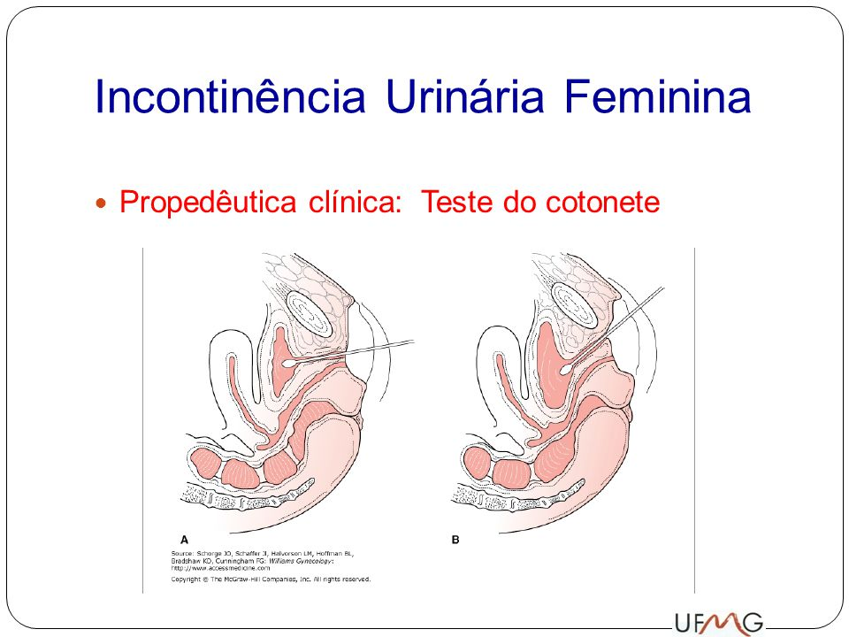 Incontinência urinária: o que é, causas e tratamento