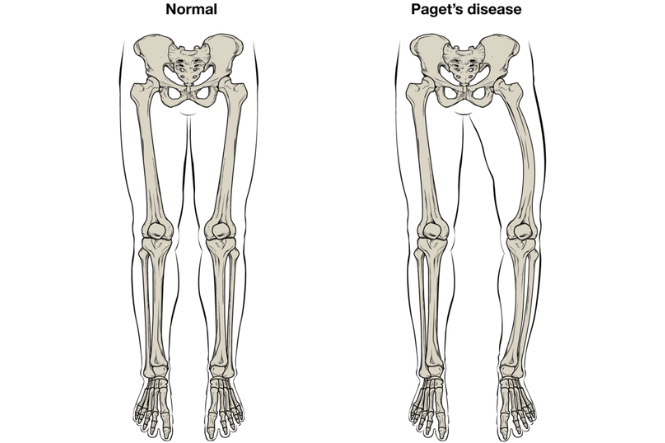 Doença de Paget: sintomas, causas, diagnóstico e tratamento