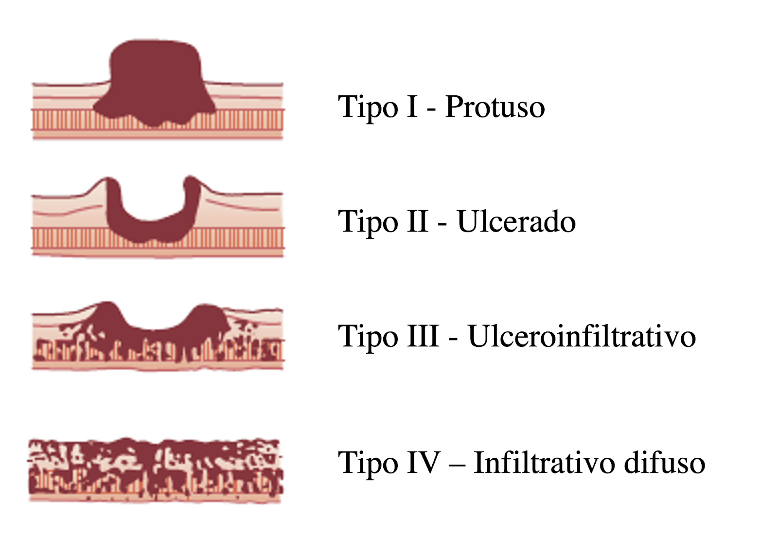Câncer de Estômago: como cai na prova de residência médica?
