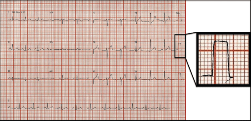 O que deve ser analisado no eletrocardiograma?