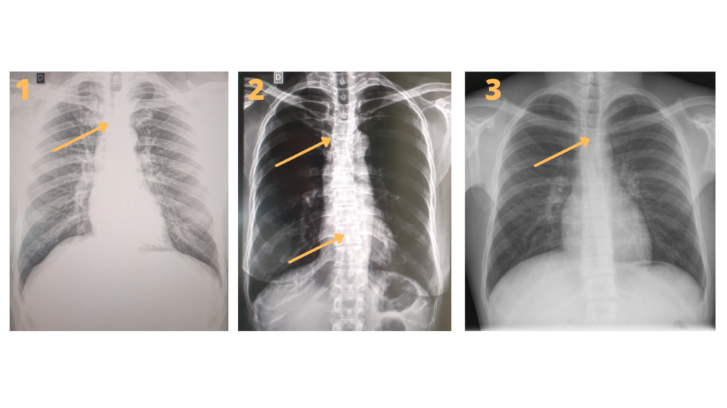 Tórax: como fazer diagnósticos através da Radiografia e Tomografia