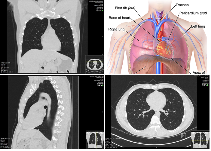 Tórax: como fazer diagnósticos através da Radiografia e Tomografia