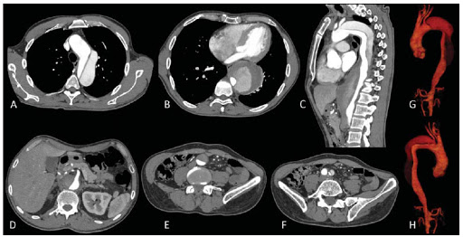 Tórax: como fazer diagnósticos através da Radiografia e Tomografia