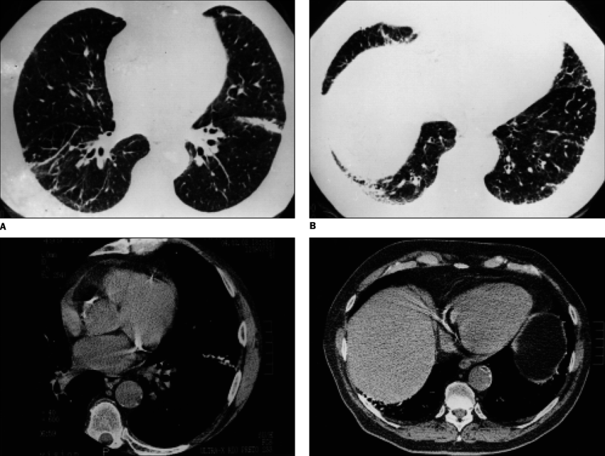 Tórax: como fazer diagnósticos através da Radiografia e Tomografia
