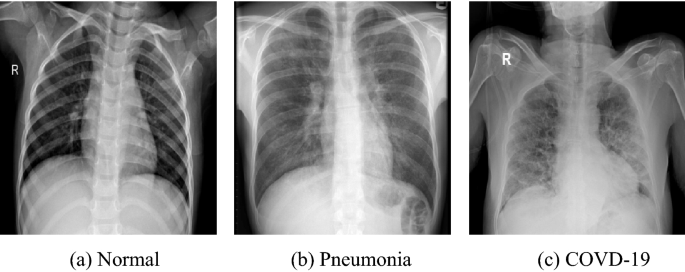 Síndrome respiratória aguda grave: o que causa, diagnóstico e como tratar
