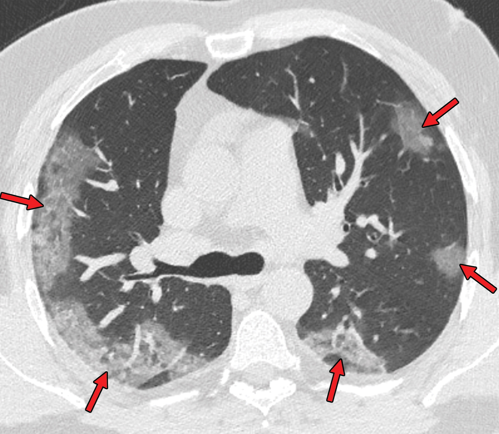 Síndrome respiratória aguda grave: o que causa, diagnóstico e como tratar