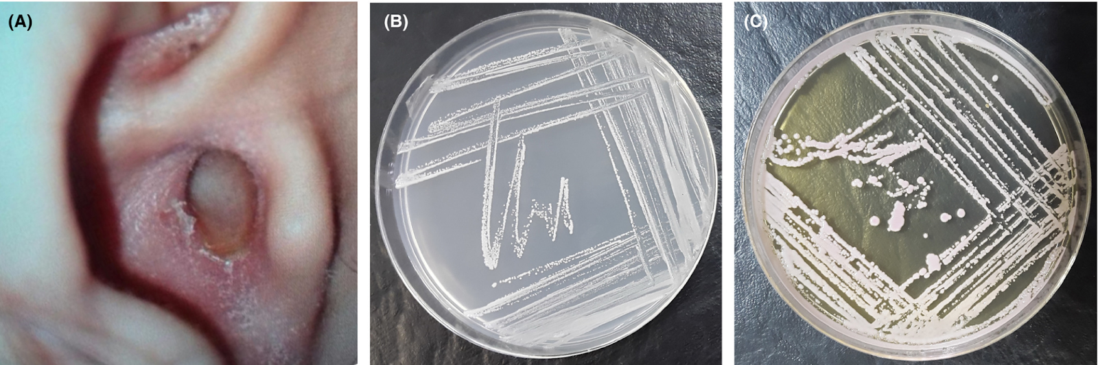 Candida auris: características, sintomas e tratamentos