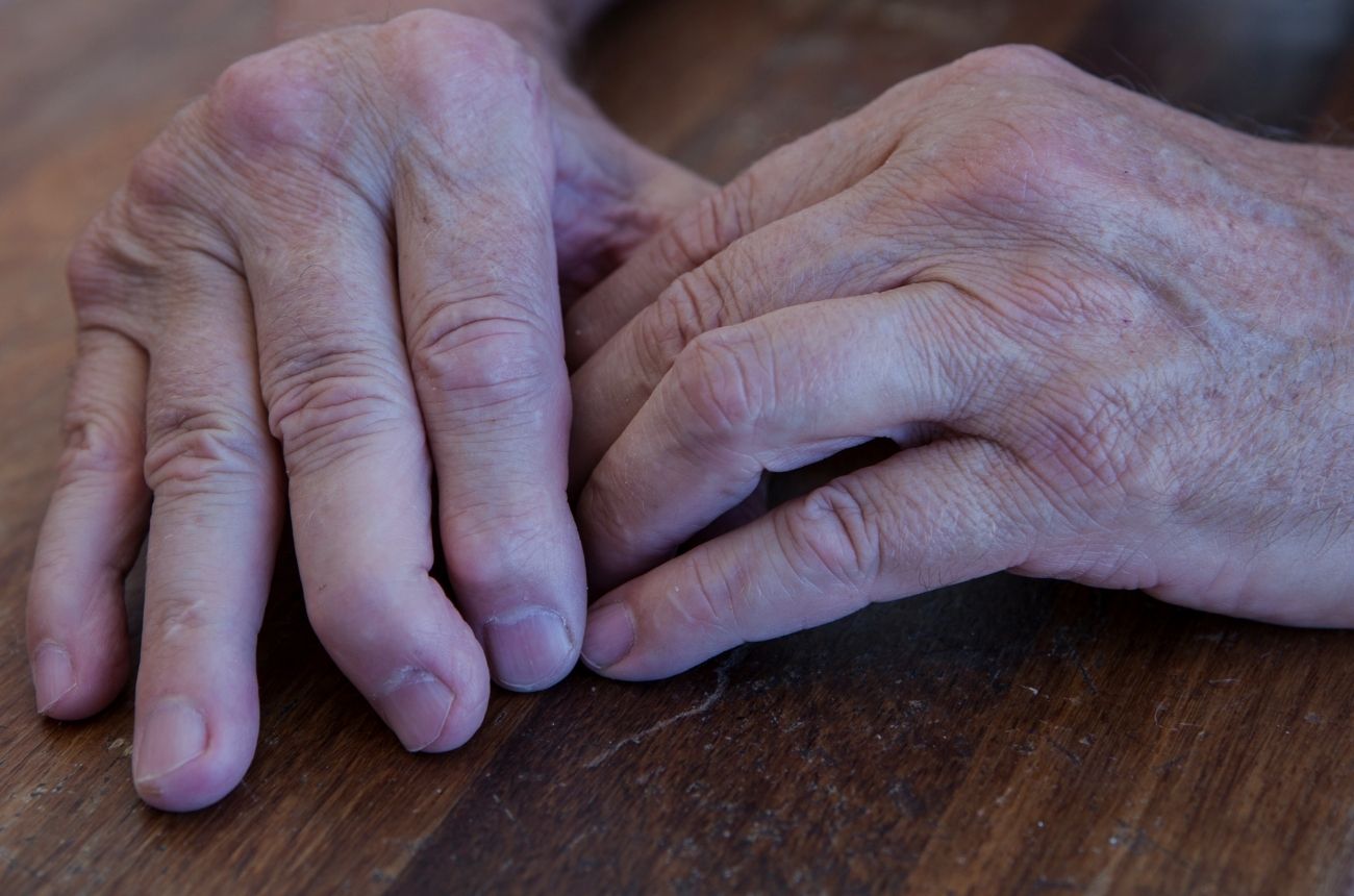 Psoriatic Arthritis: Meaning, Symptoms, Types, Causes & Treatment ...