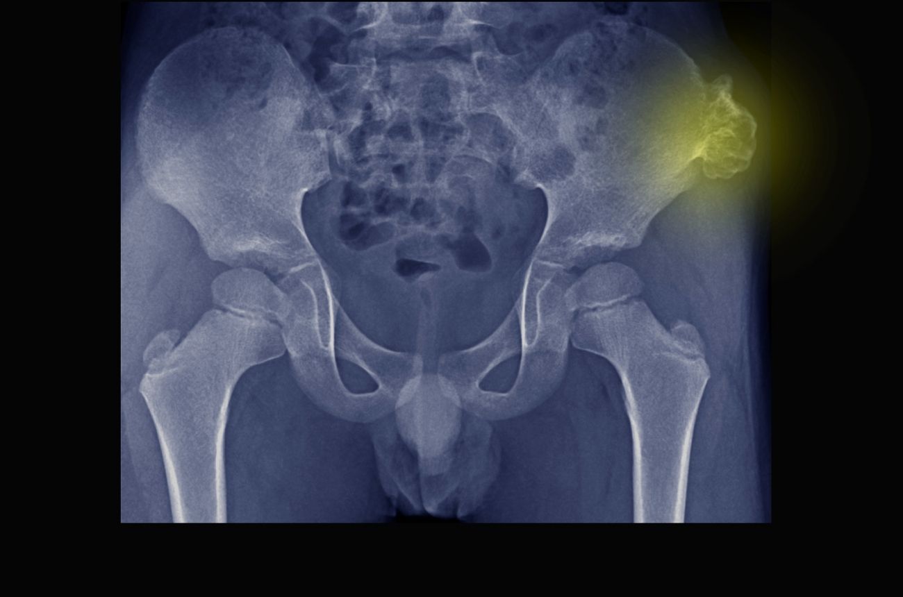 Osteochondroma - Symptoms, Types, Causes, Prevention & More - blog.cult.fit