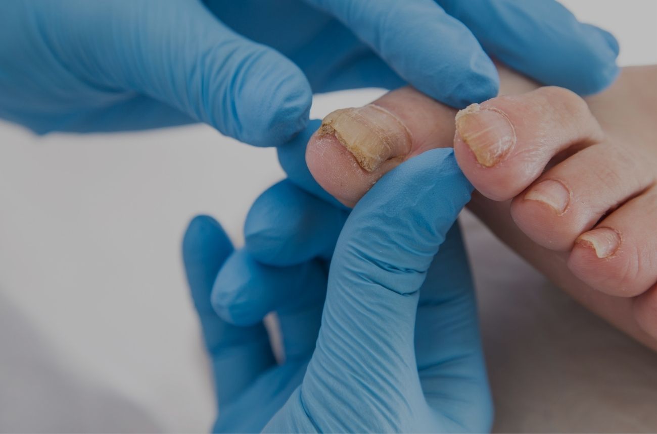 Ingrown toenail Symptoms, Reasons, Diagnosis, Causes, & Treatment At ...