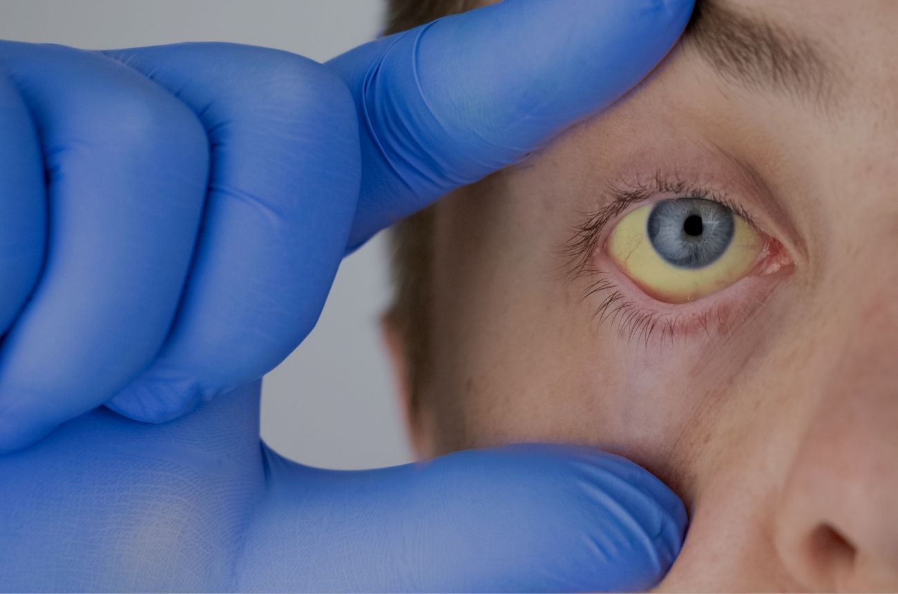 Gilbert Syndrome: Symptoms, Causes, Treatment, Prevention | cult.fit