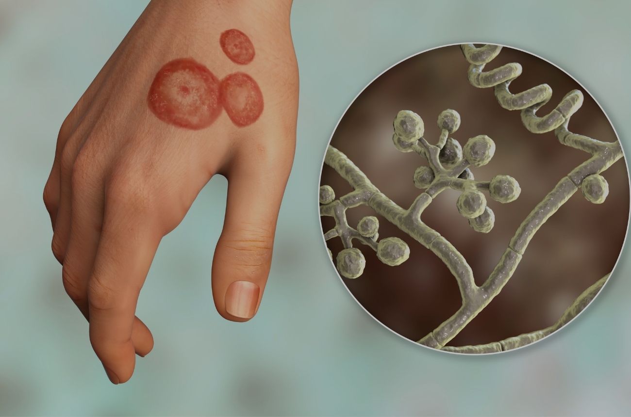 Dermatophytosis : Symptoms, Causes, Treatment & More | cult.fit
