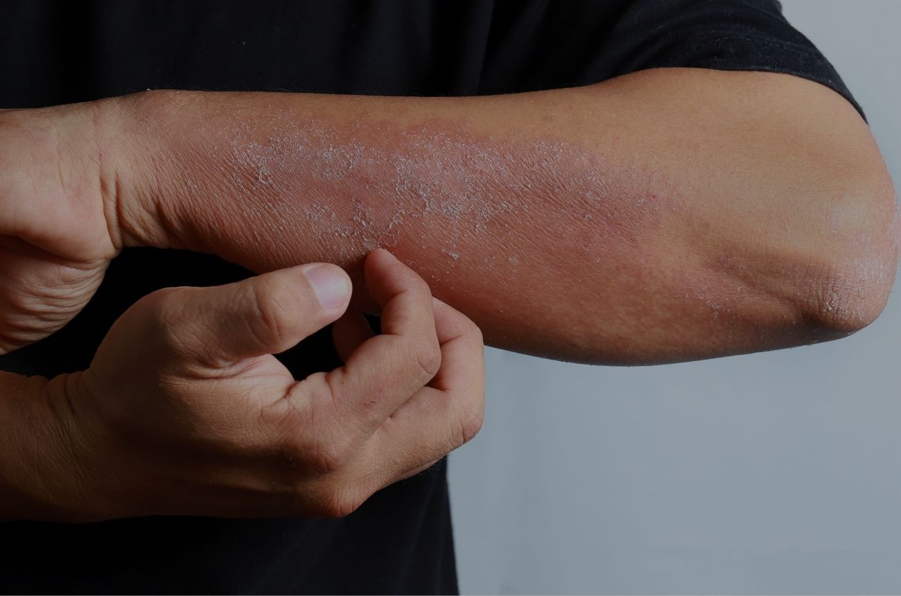 Dermatitis: Types, Symptoms, Causes, Diagnosis & Treatment | cult.fit