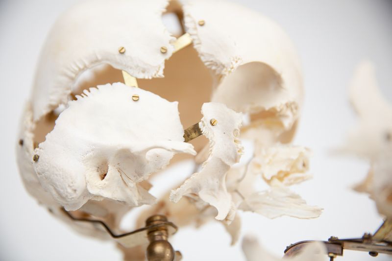 Adolescent exploded skull | JonsBones: Responsibly Sourced Human Osteology
