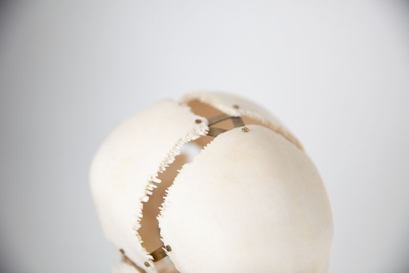 Adolescent exploded skull | JonsBones: Responsibly Sourced Human Osteology