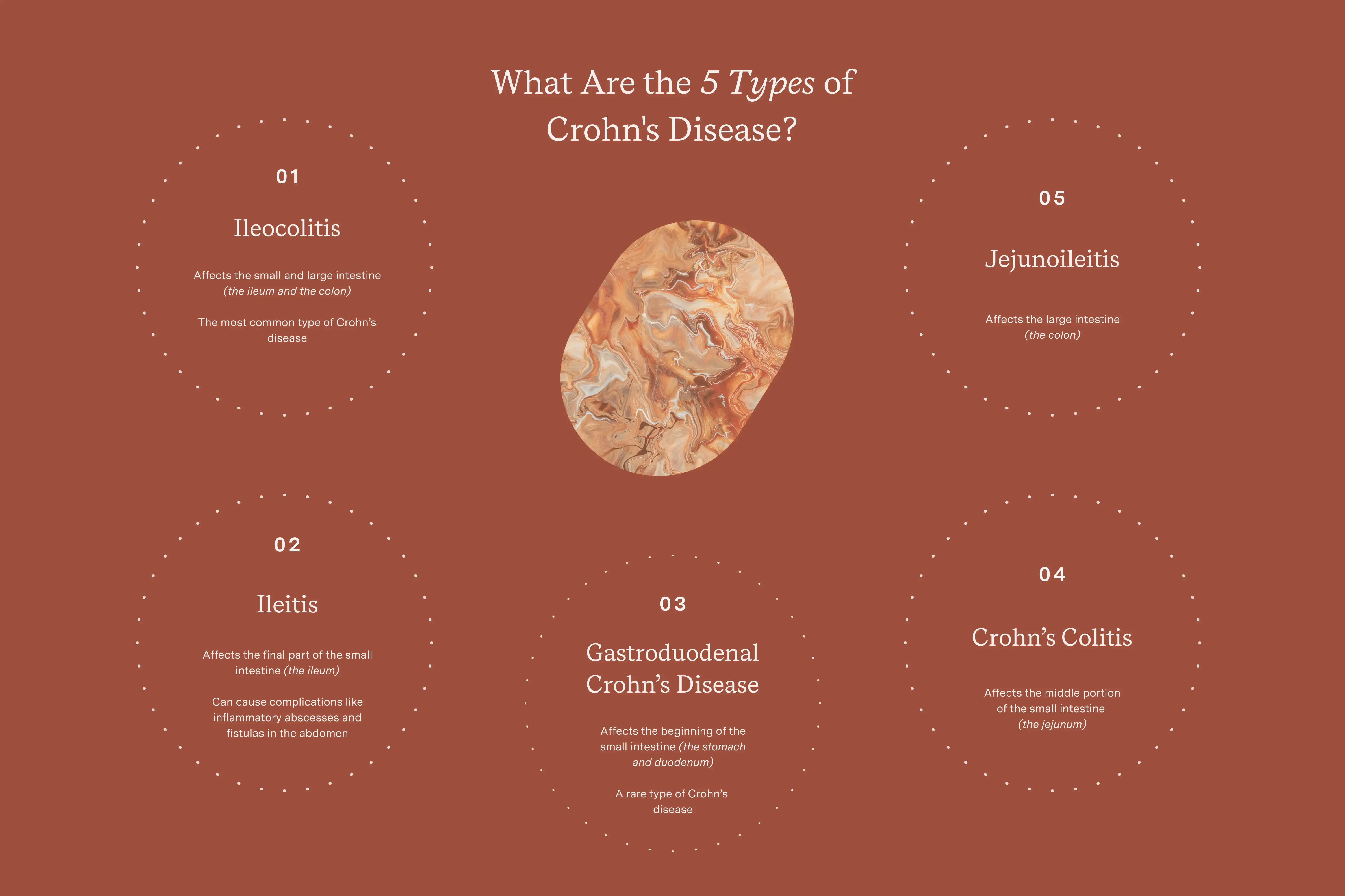 What Are the 5 Types of Crohn's Disease? A Beginner's Guide to IBD Care