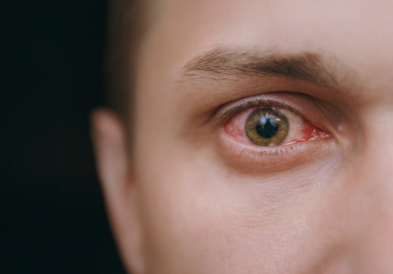 El sol en los ojos ¿Cómo afecta? | Clínica Oftalmológica TACIR