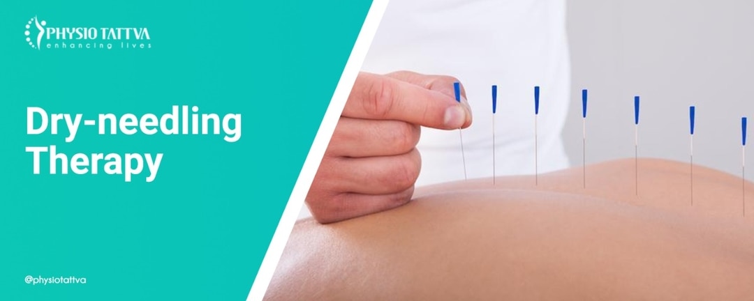 Professional Dry Needling Therapy- What You Need to Know