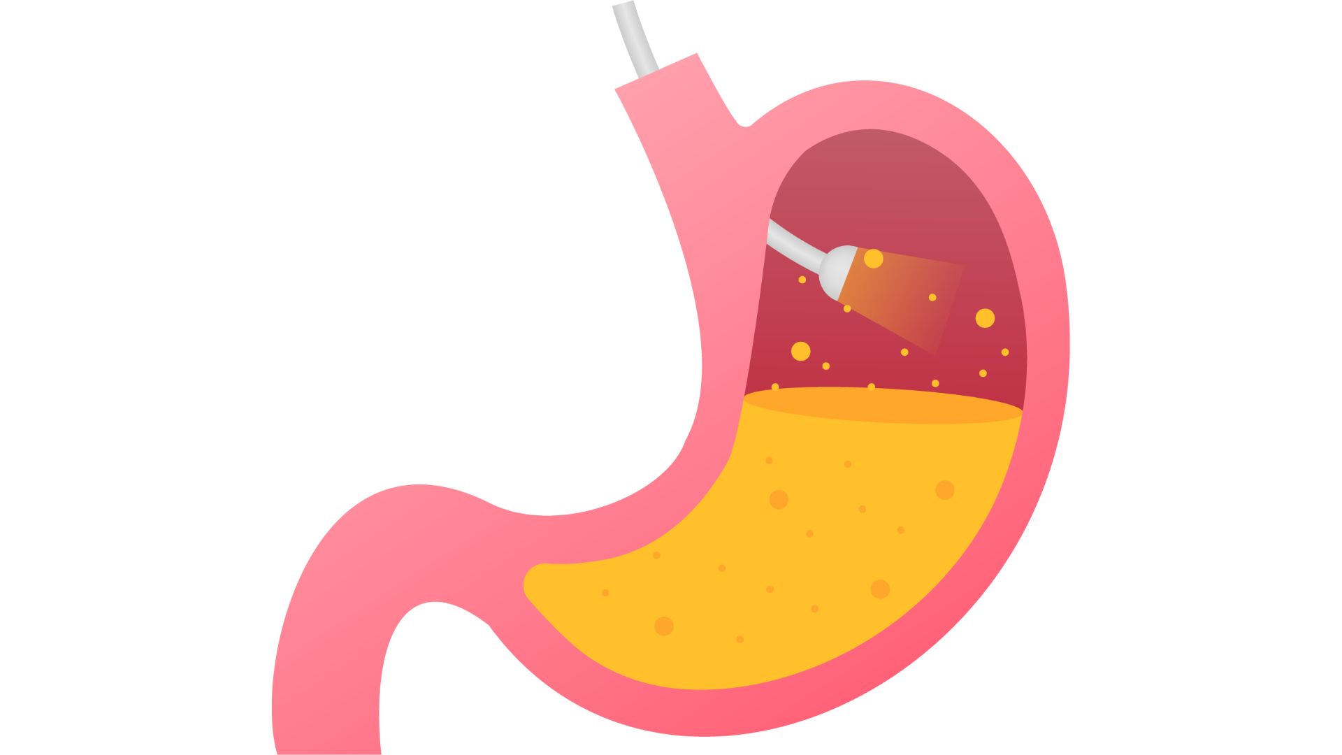 Gastric Fibroscopy • Information & Tips • Hoopcare