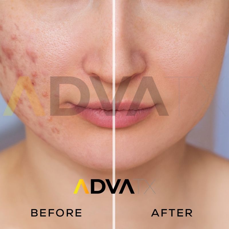 Advalight Laser Treatment