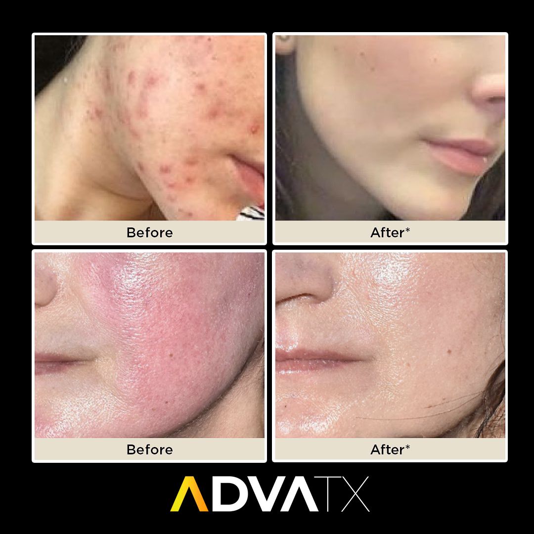 Advalight Laser Treatment