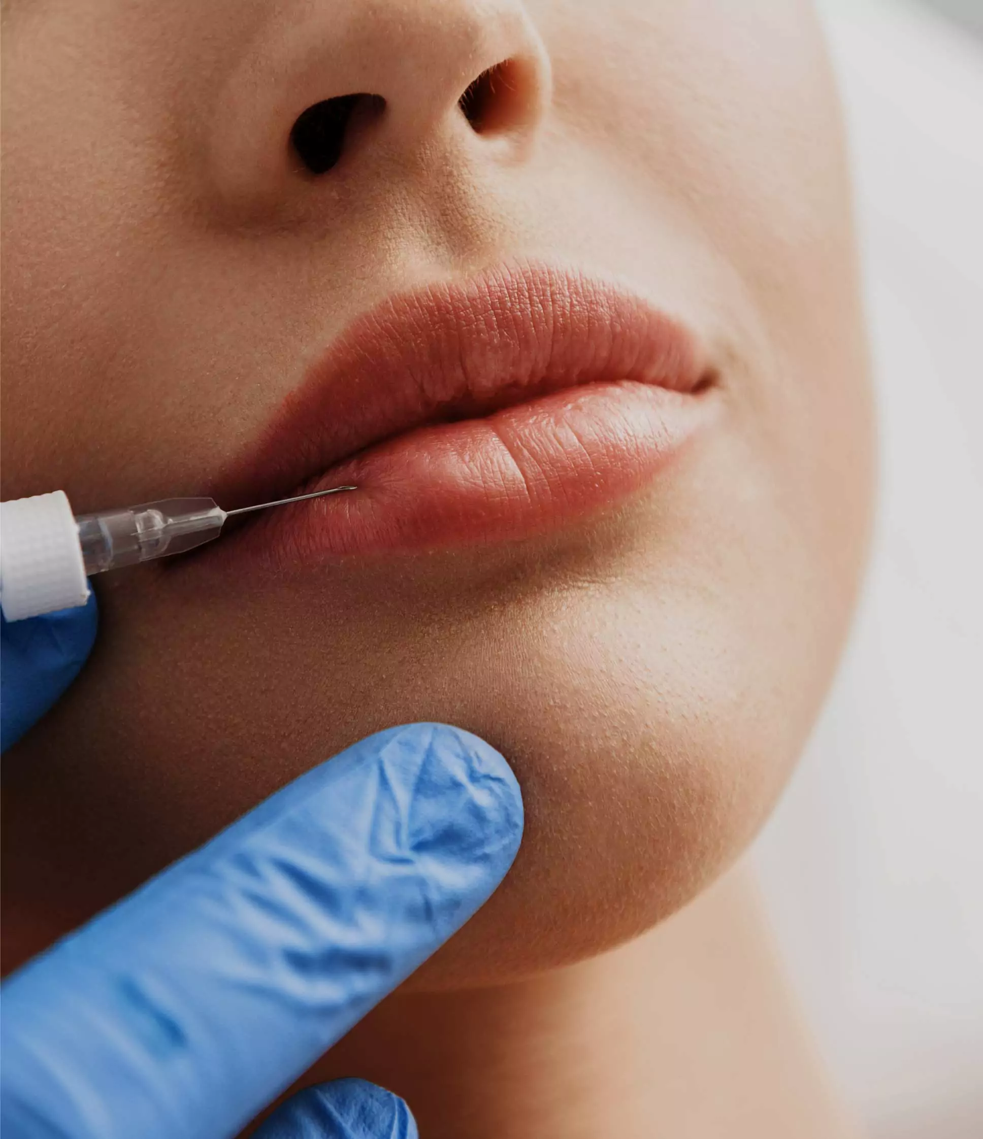 “How my relationship with my skin changed after getting fillers”: Aanam ...