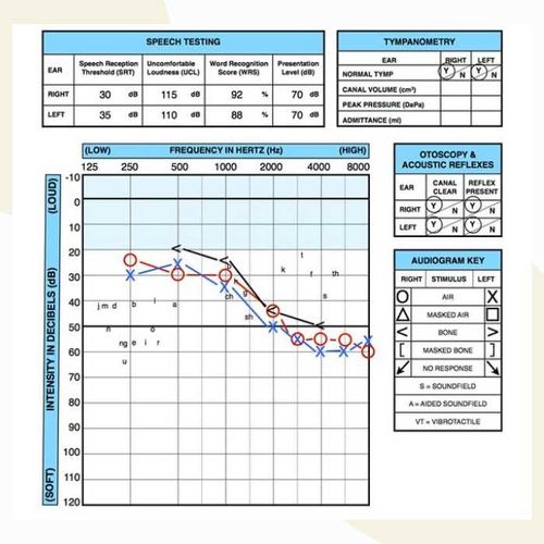 How to Read an Audiogram | Dr. Amy Sarow Explains