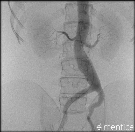 Renal Denervation | Software