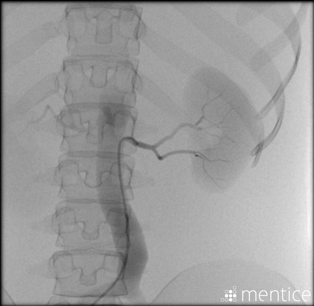 Renal Denervation | Software