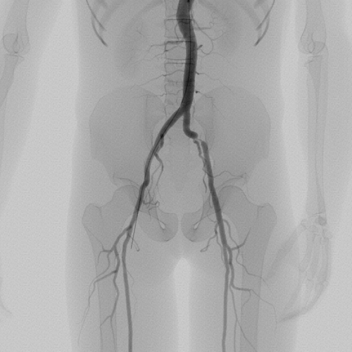 Peripheral Angiography | Software