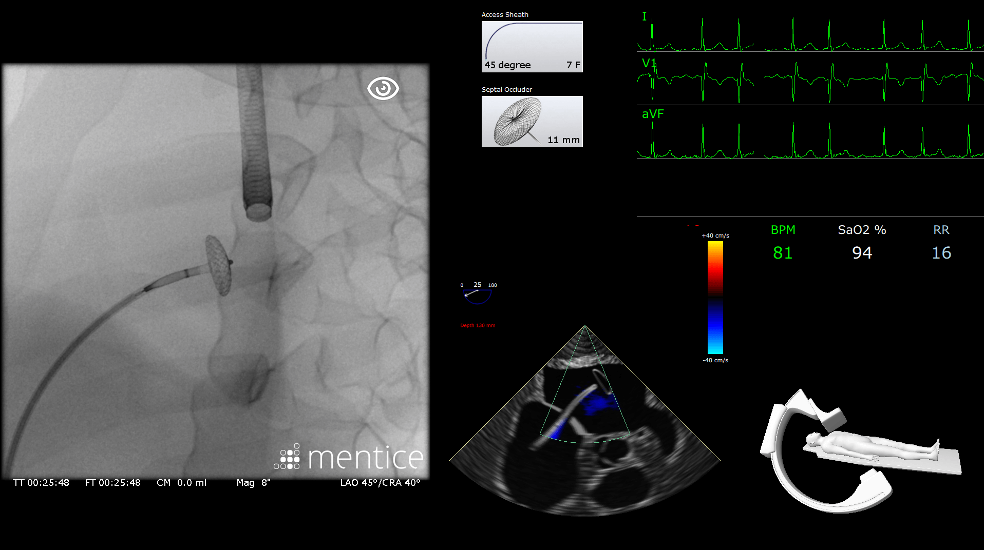 Atrial Septal Defect and Patent Foramen Ovale Occlusion | Software