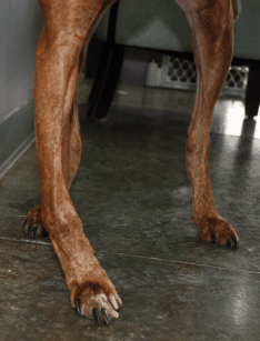 Prosthetics Basics and Subtotal Amputation