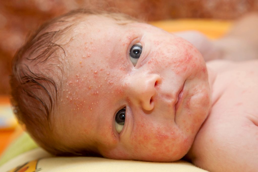 Baby Eczema Vs Other Skin Conditions Blueberry Pediatrics Baby Eczema Vs Other Skin Conditions Blueberry Pediatrics