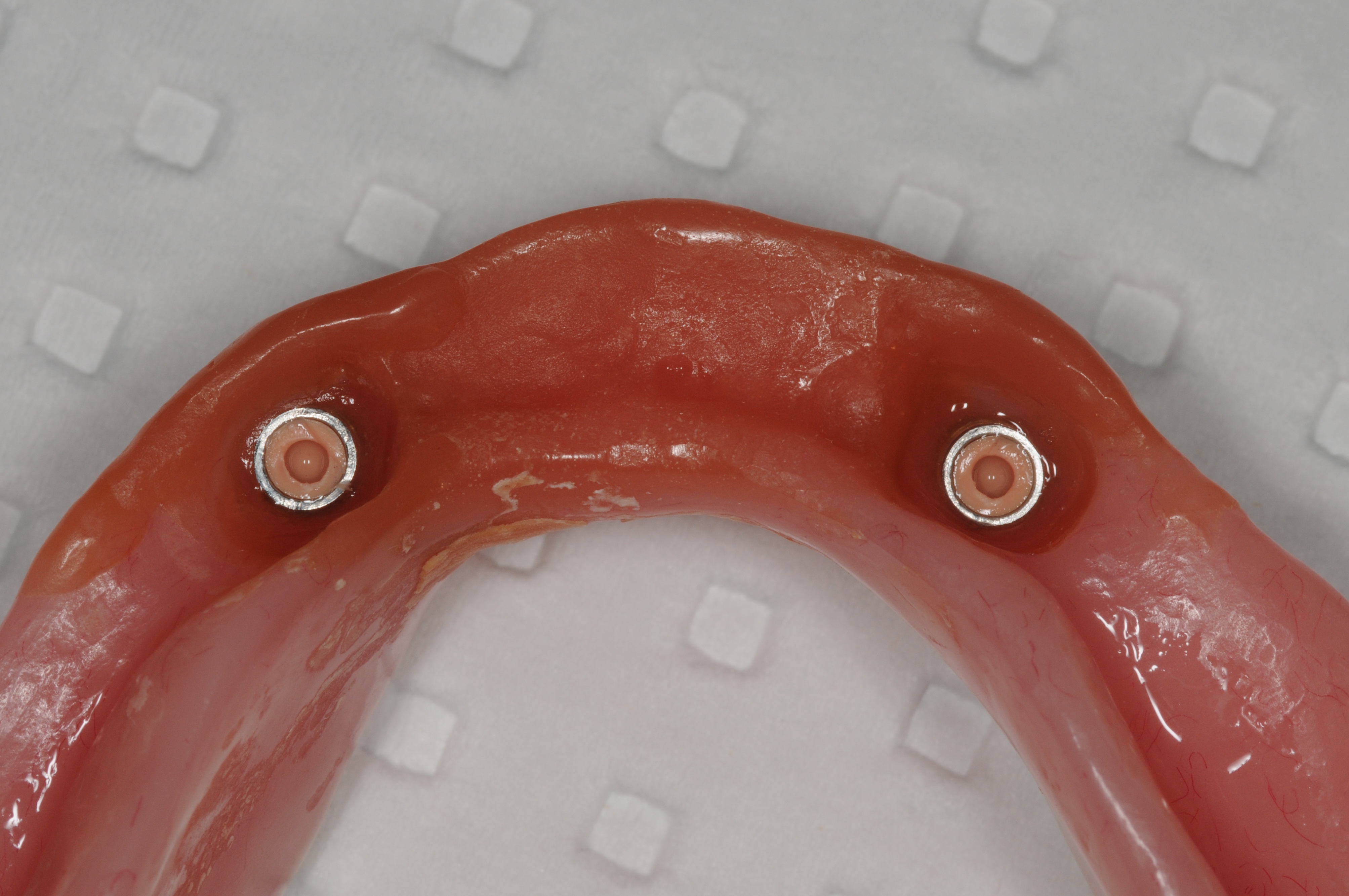 Services: Over Dentures | Brisbane Prosthodontics