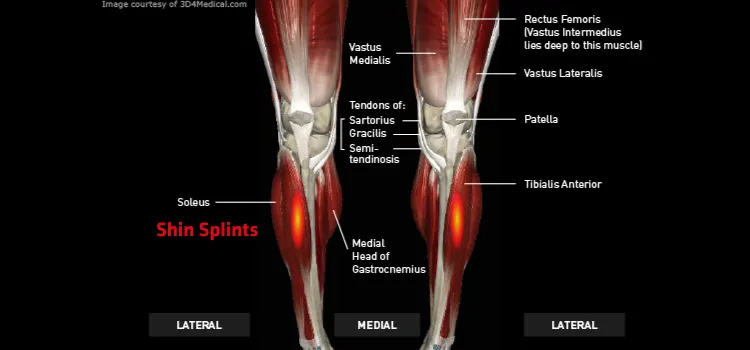 Shin Splints Treatment in Sydney - Orthotic Solutions Podiatry