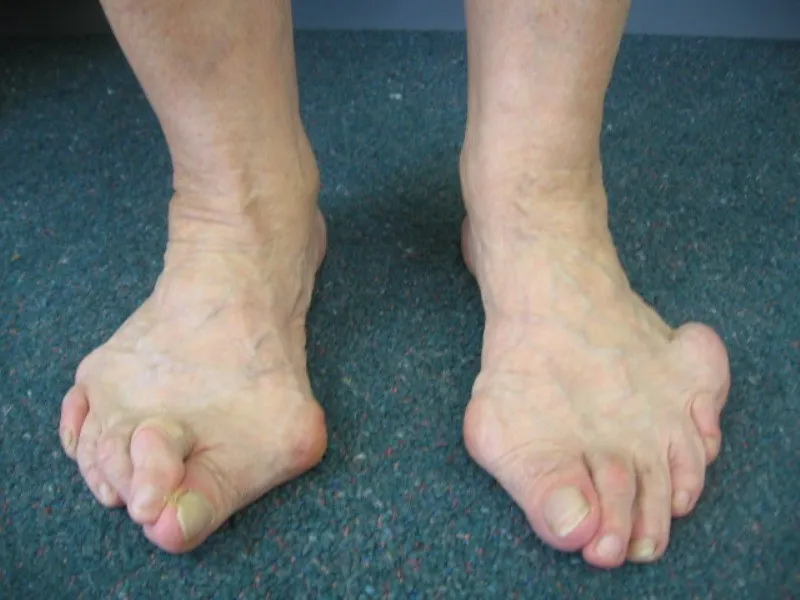 What Are Bunions? | Orthotic Solutions Podiatry